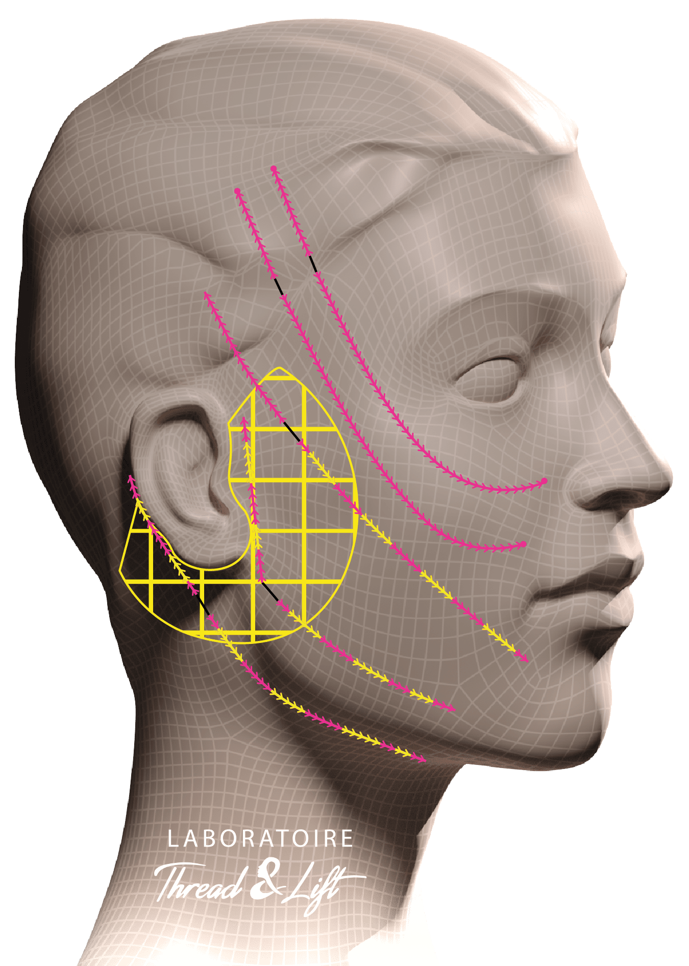 Our solution - Infinite-Thread® & Parallel technique | Thread & Lift